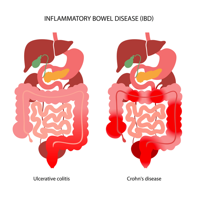 Understanding Inflammatory Bowel Disease (IBD): What is Crohn's and Colitis? - Oxford Colon ...